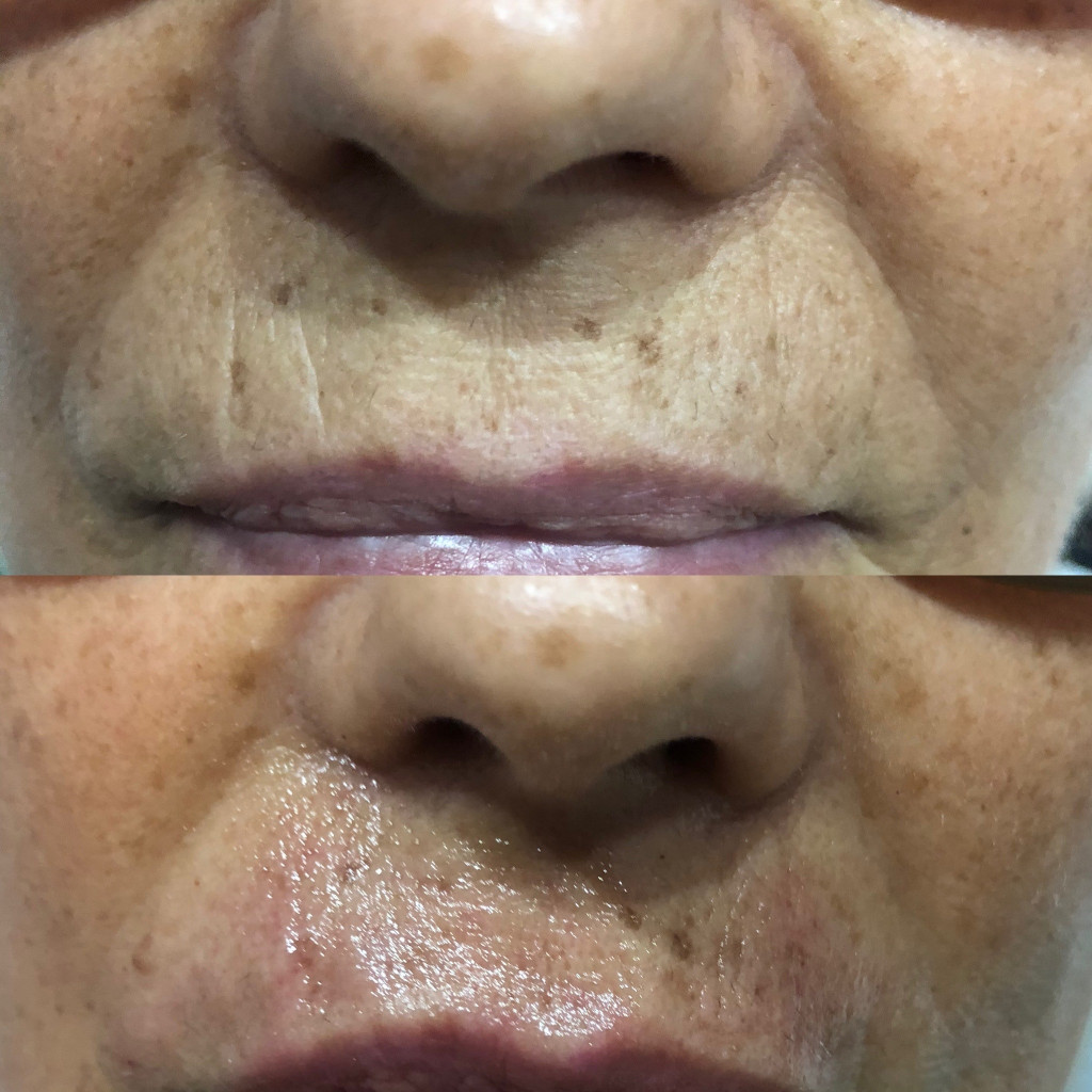 Peeling - Tratamento de Pele na Clínica Medway