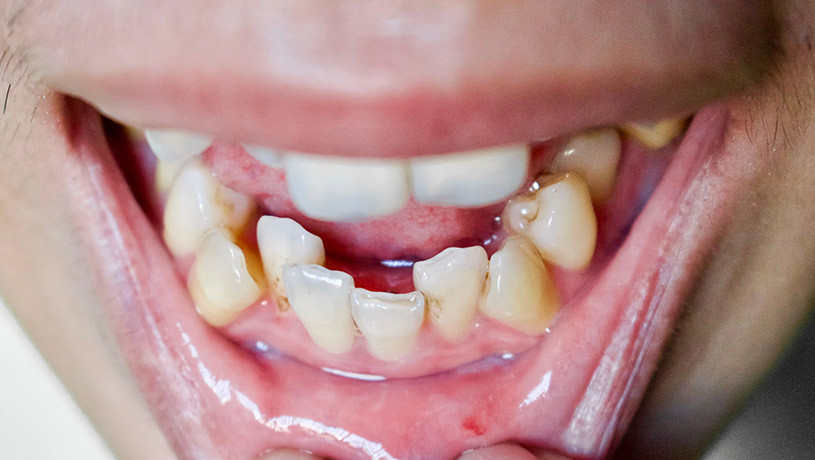 Dentes Separados ou Dentes Apinhados: o Invisalign corrige?