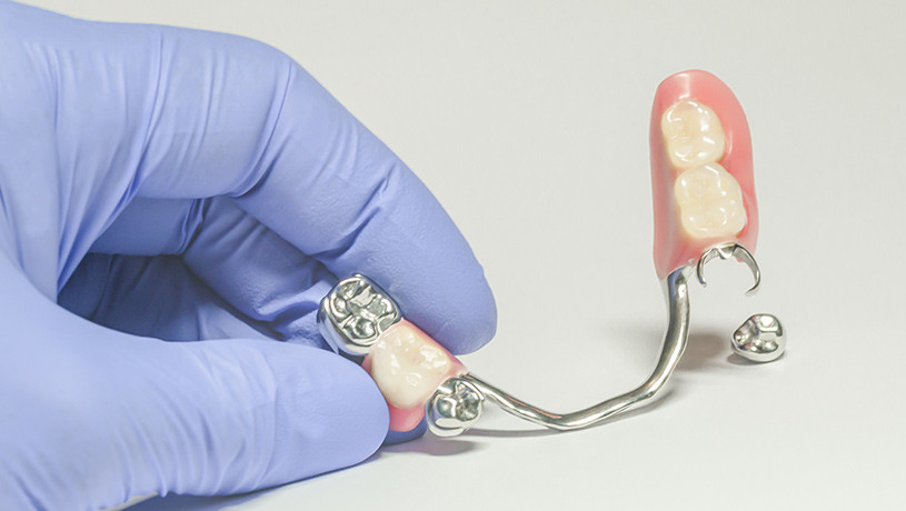 Tudo sobre Prótese Dentária Removível: tipos e durabilidade