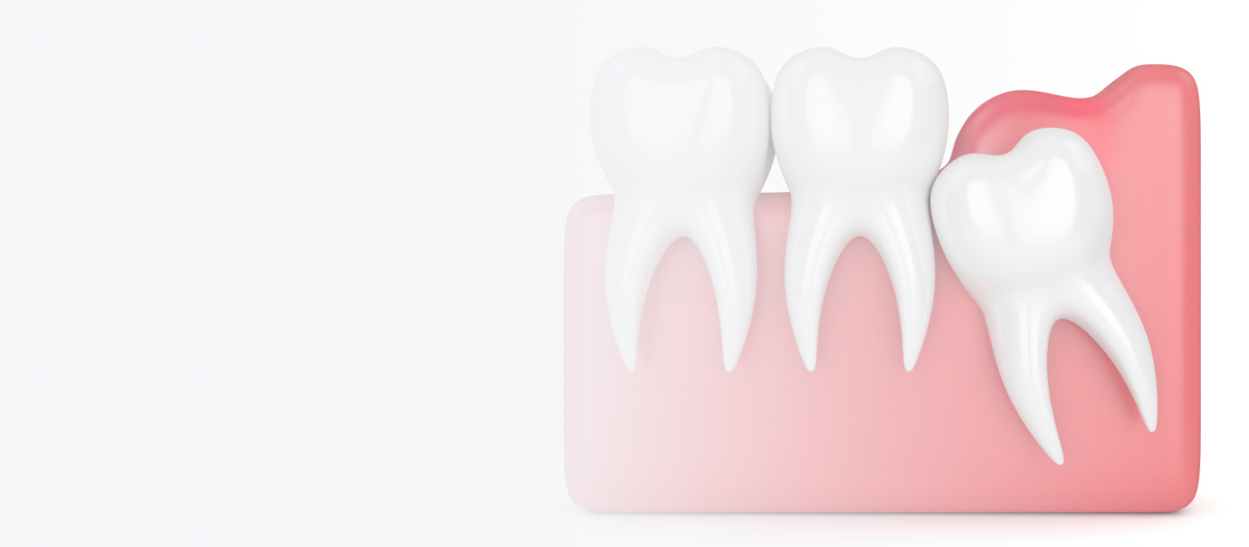 Dentes do Siso | Clínica Médica e Dentária Medway