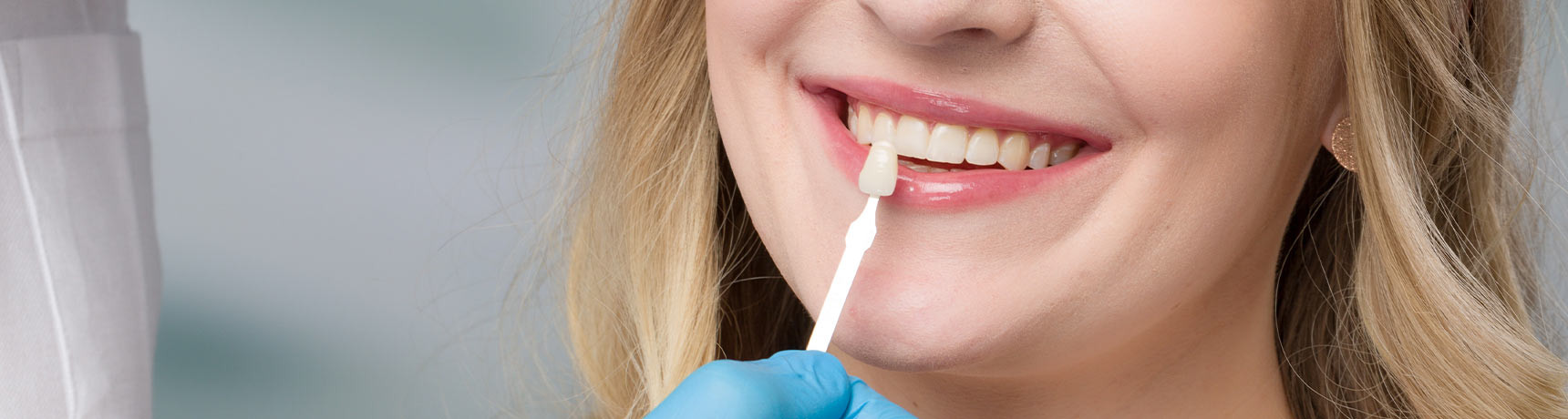 Quanto custa aplicar facetas dentárias na zona do Porto?