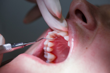 Periodontologia | Tratamento da Periodontite no Porto / Gaia